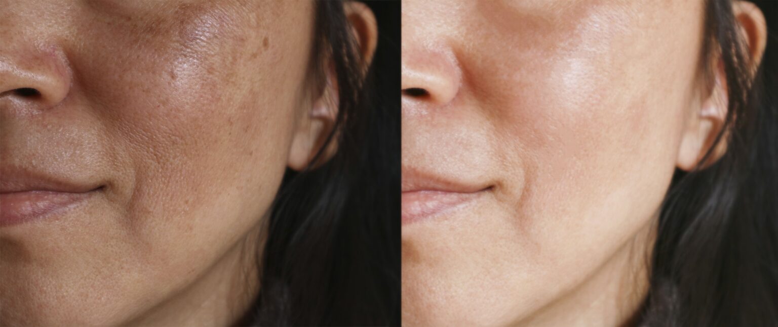 What Kind of Hydroquinone Treatment Is Right For you? - Bubba Skincare